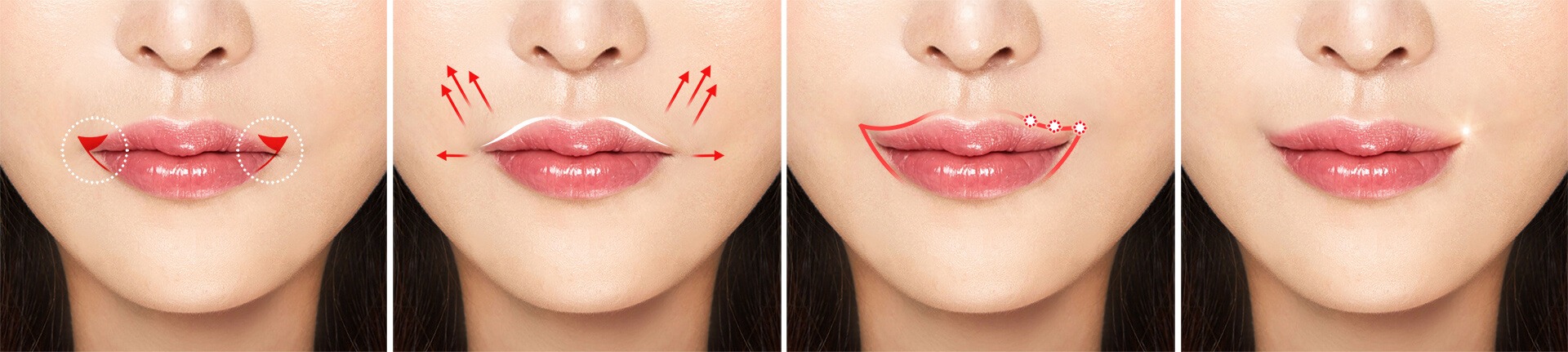 همه چیز درباره لیفت لب بالا در استانبول – اصلاح حجم لب بالا و فاصله از ...